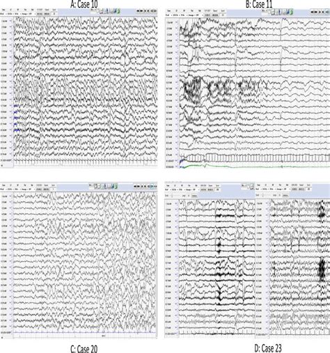 24 Hour Video EEG In The Evaluation Of The First Unprovoked Seizure PMC