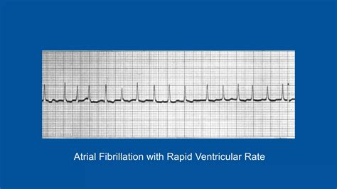 Ecg And 12 Lead Ecg Pptx