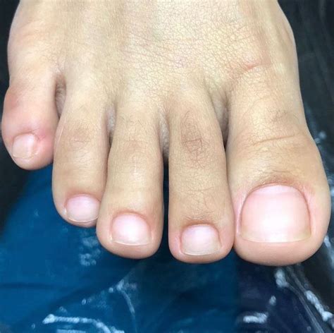 Как правильно стричь ногти Центр подологии №1 Podofocus Дзен