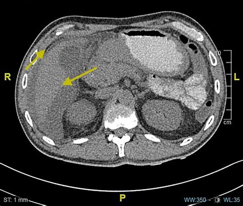 Abdominal Ct Scan Shows Pneumoperitoneum Secondary To Perforated Viscus