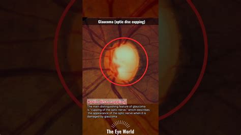 Optic Nerve Cupping What You Must Know To Protect Your Sight