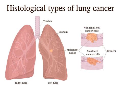 4 Types Of Lung Cancer