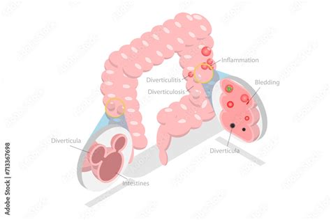 3d Isometric Flat Conceptual Illustration Of Diverticulosis And Diverticulitis Medical