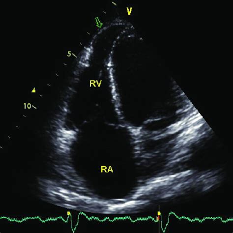 Biventricular Dysfunction In A Patient With Chagas Disease Superior