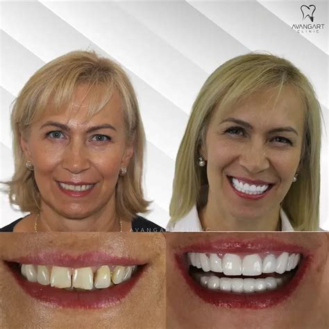 Day By Day Wisdom Teeth Recovery Timeline What To Expect