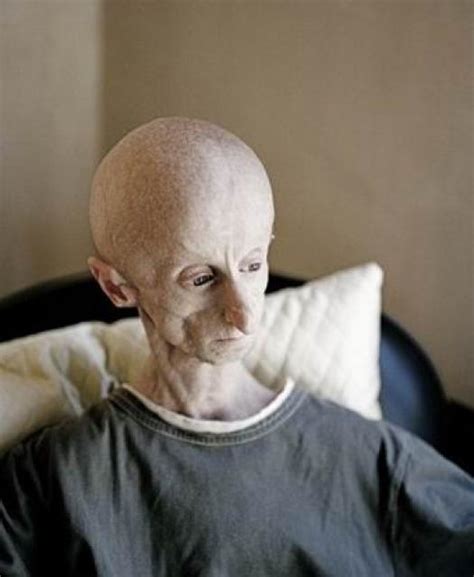 Leon Botha Biography South African Artist Hip Hop Musician And Dj Who Suffered From Progeria