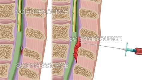 Epidural Blood Patch Procedure Illust Stock Image Science Source