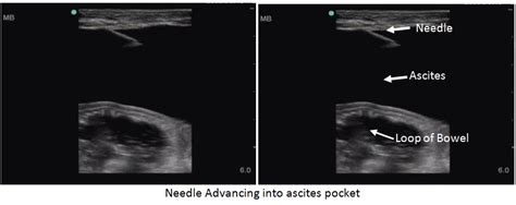 Ultrasound Guided Paracentesis Educational Resources