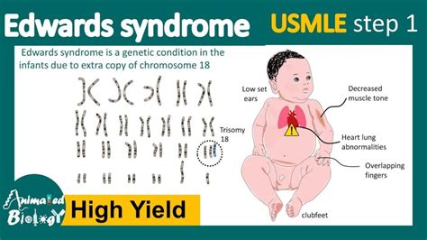 Understanding Edwards Syndrome Causes Symptoms And Treatment
