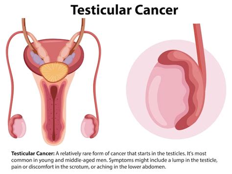 Testicular Cancer Diagram Treatment Of Testicular Cancer In