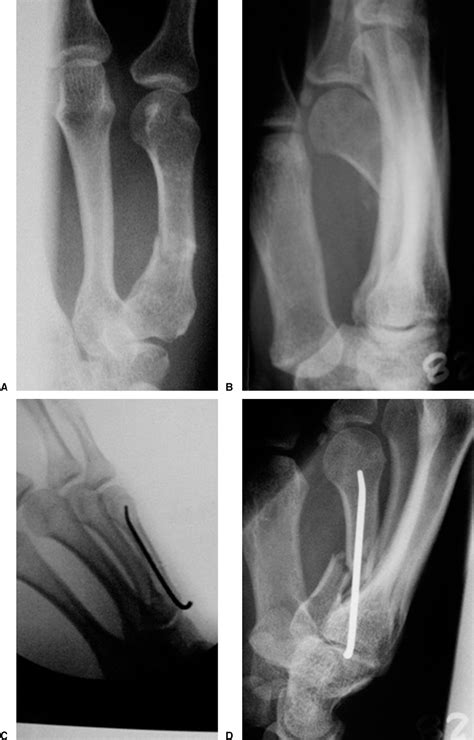 Figure 1 From Comparison Of Intramedullary Nailing Versus Plate Screw