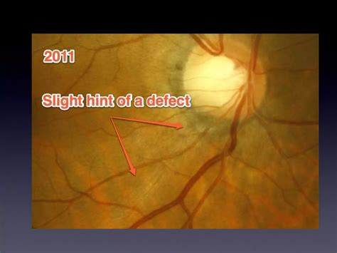 Imaging In The Detection Of Glaucoma Ppt Eye And Vision Conditions Diseases And Conditions