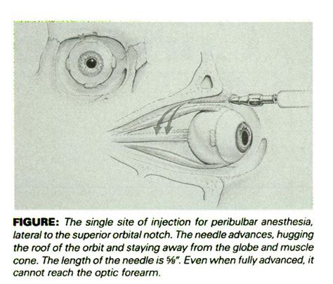 Peribulbar Injection