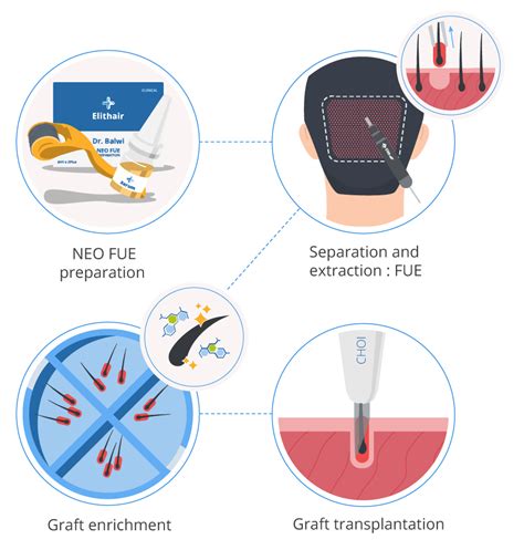 A Hair Transplant At The Worlds Largest Clinic Elithair