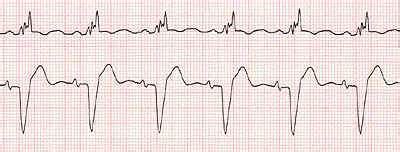 London Ambulance Unofficial ECG EKG