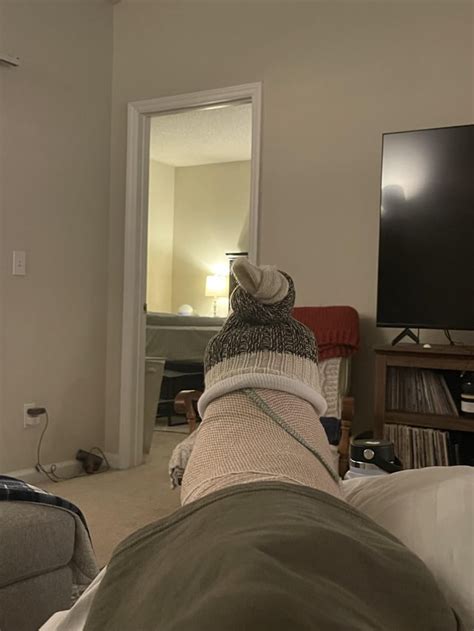 Fibula Fracture R Brokenbones