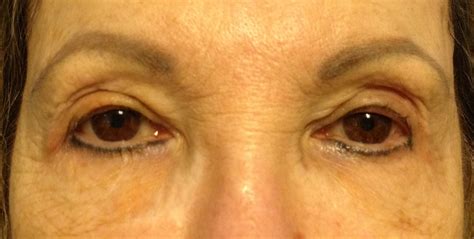 Cosmetic Reconstructive Surgery New York City Orbit Surgery Manhattan