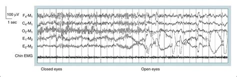 Sleep Staging In Adults Neupsy Key