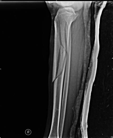 Biological Fixation Comminuted Fracture Proximal Tibia And Shaft My