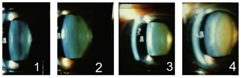 Cataract Classification Or Grading Florida Cataract Doctor