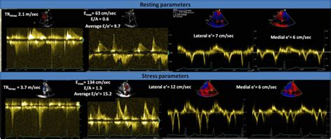 An Example Of Positive Diastolic Stress Test In A 72 Year Old Man With