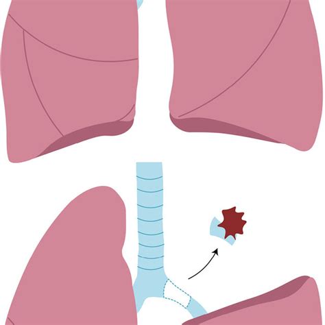 Scheme Presenting Typical Bronchial Sleeve Lobectomy Download Scientific Diagram