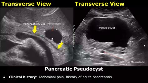Pancreas Ultrasound