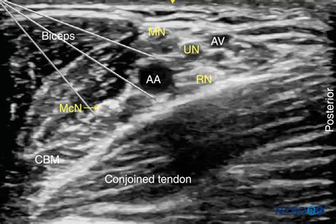 Ultrasound Guided Axillary Brachial Plexus Block Nysora