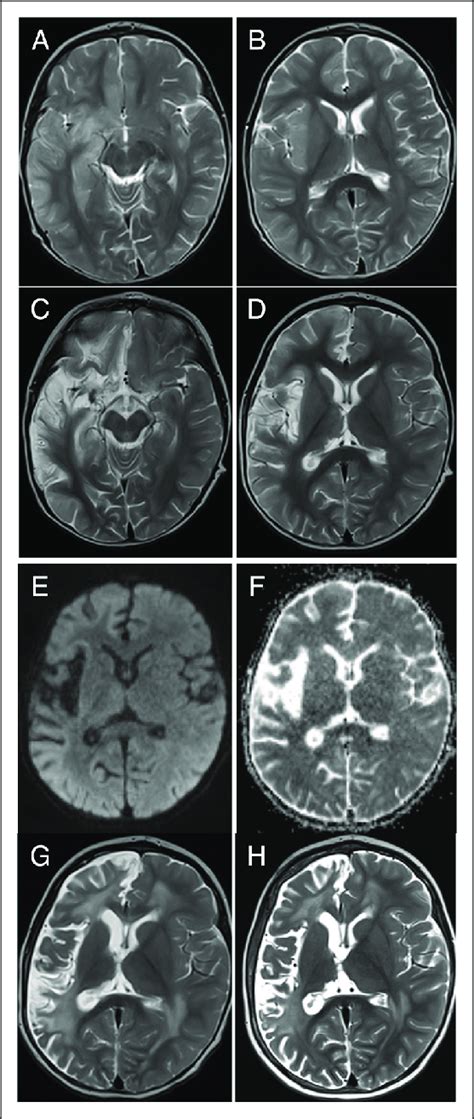 Axial Mri Brain Images A And B Mri T2 Sequences Performed At Day
