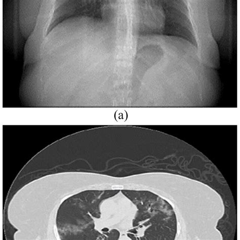 A Chest X Ray Posteroanterior View Shows Ill Defined Bilateral Download Scientific Diagram