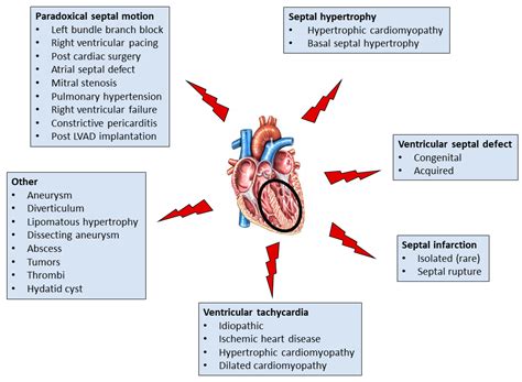 Jcm Free Full Text The Interventricular Septum Structure Function Dysfunction And Diseases