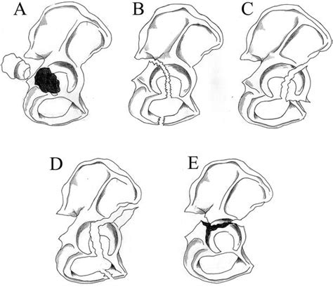Clinical And Radiological Assessment Of Acetabular Fracture IntechOpen