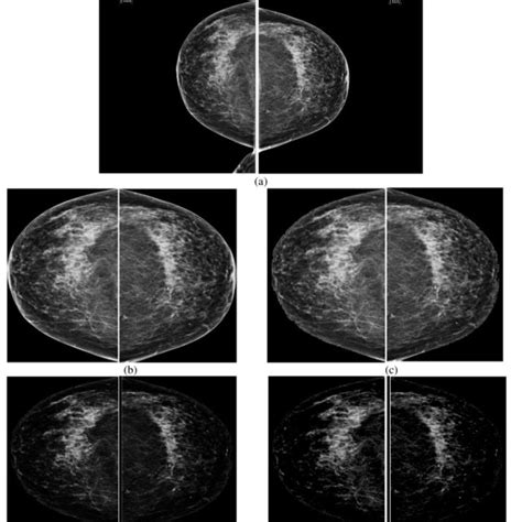 PDF Improving Performance Of Breast Cancer Risk Prediction Using A