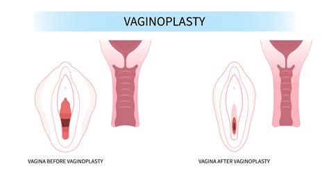 Vaginoplasty Procedure Cost Risks And Benefits Recovery
