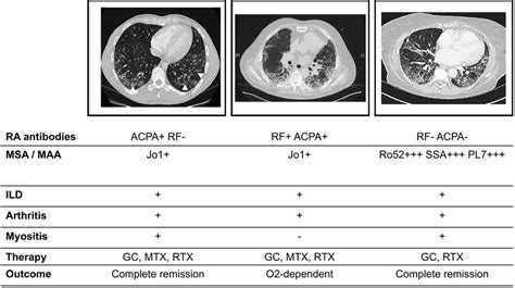 Antijo 1 Syndrome Often Misdiagnosed As Rheumatoid Arthriti Jcr