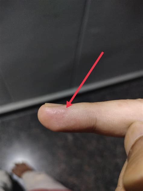 Is This Ezcema Or Dyshydrotic Ezcema Rraynauds