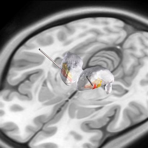 Types Of Encephalitis A Mayo Clinic Expert Explains Mayo Clinic News Network