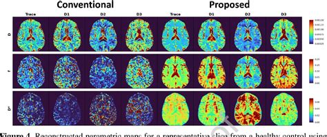 Figure 1 From High Fidelity Intravoxel Incoherent Motion Parameter Mapping Using Locally Low