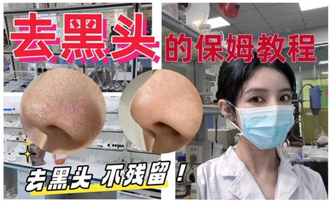 满鼻子黑头，碰一下就流出油怎么办？黑头在鼻子上就地扎根是不是没救了？【专业人士】教你科学搞定黑头问题，1个月快速见效！ 知乎