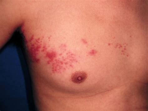 Unknown Non Itching Skin Rash Pityriasis Rosea Healthdirect