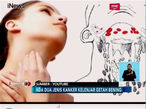 Biji Angin Di Leher James McLean