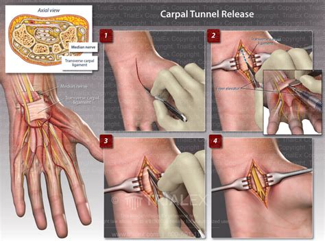 Carpal Tunnel Release Trialquest Inc