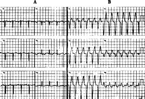 Figure 1 From Exercise Induced Left Bundle Branch Block During Thallium 201 Myocardial Perfusion