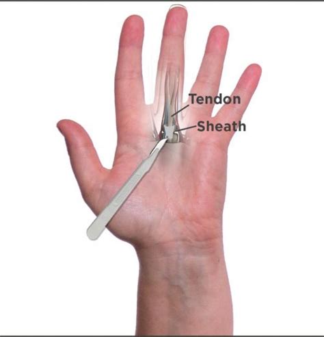 Trigger Finger Release Genesis Orthopedic And Sport Medicine
