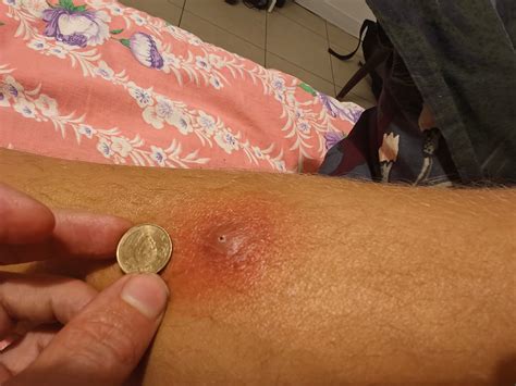Spider Or Bee Bite Troubling Me Since Days Health And Fitness Forumosa