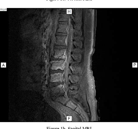 Staphylococcus Aureus Meningitis Semantic Scholar