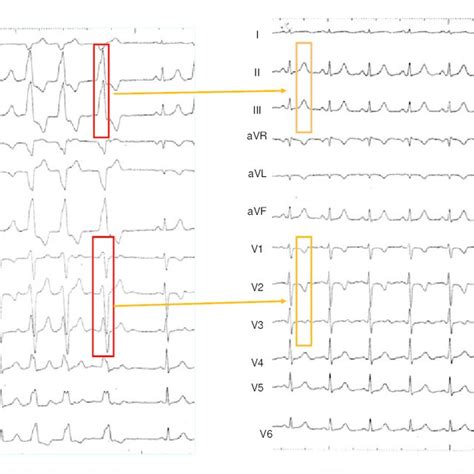 Induction Of Ventricular Repolarization Memory By Right Ventricular