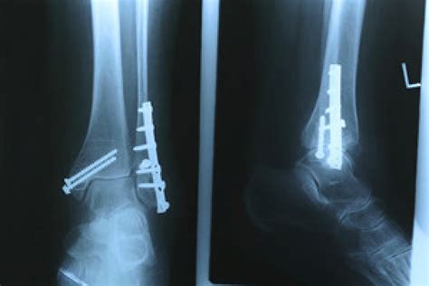 Orif For An Ankle Fracture