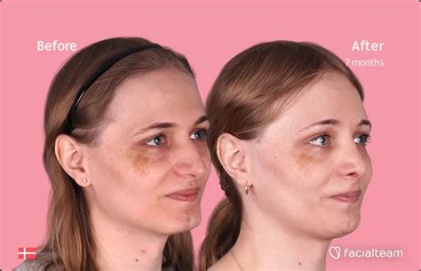 Thea Before And After Ffs Surgery — Facialteam