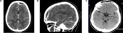 A Axial Ct Brain With Subdural Empyema B Sagittal Ct Scan With Download Scientific Diagram